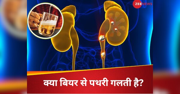beer make kidney stone pass out through urine doctor shared pathari ...