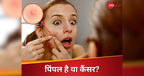 Pimple or cancer sign dermatologist reveals some clue that your tiny ...