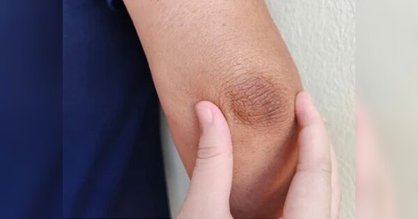 How To Clean Dark Elbows Naturally With Simple Home Remedies | कोहनी के ...