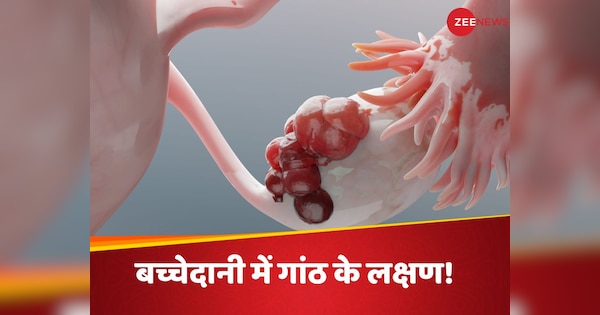 बच्चेदानी में गांठ के लक्षण | lump in the uterus Signs | बच्चेदानी में ...