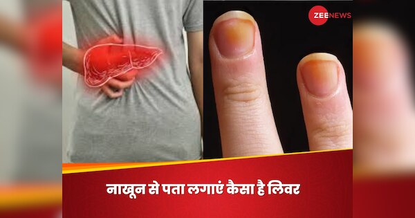 Liver Disease Symptoms Warning Signs From Nails Nakhoon se Bimari Ke ...
