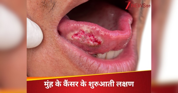 early symptoms of oral cancer | मुंह के कैंसर के शुरुआती लक्षण | muh ke ...