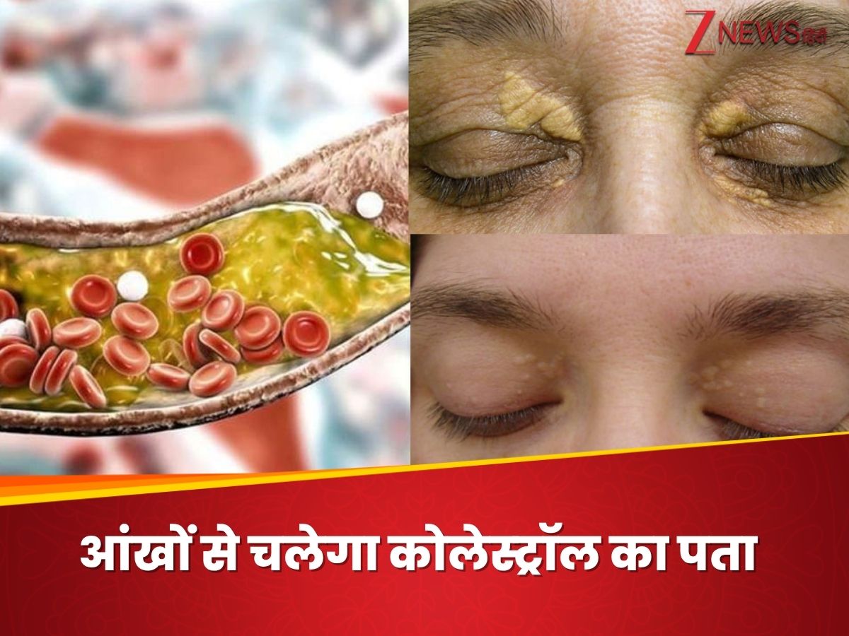 Top 5 High Cholesterol Warning Sign Symptoms in Eyes Xanthelasma Arcus ...