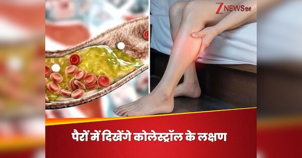 Feet Shows High Cholesterol LDL Warning Signs Symptoms Leg | पैरों में ...