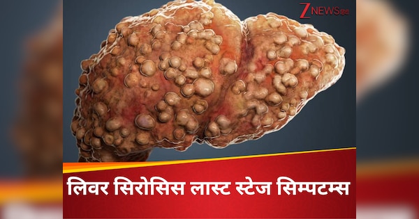 Liver on verge of rotting melting rush to doctor as these 5 symptoms of ...