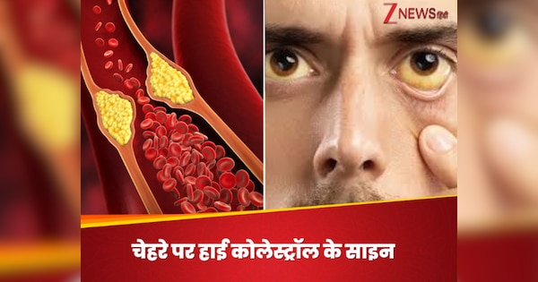 Symptoms of high cholesterol will be visible on the face just Find ...
