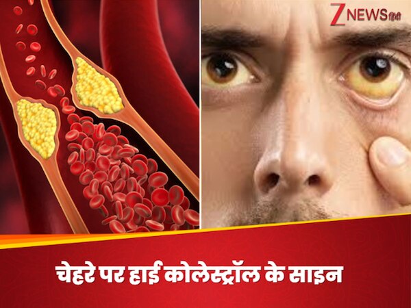 Symptoms of high cholesterol will be visible on the face just Find ...