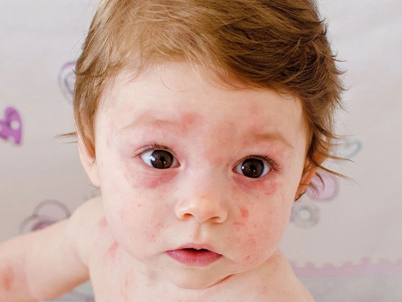 what is roseola virus why this infection affects children by age 2 ...