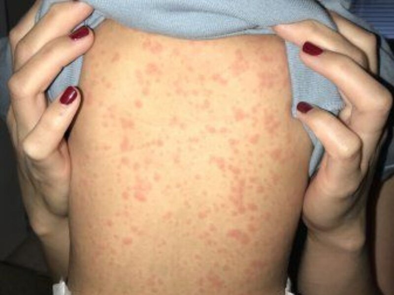 what is roseola virus why this infection affects children by age 2 ...