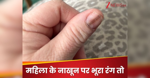 light brown line on the nail revealed a serious disease true story of ...