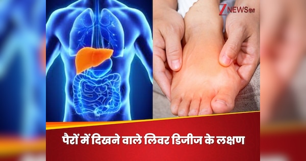 What are the symptoms of liver disease seen in leg areas Swelling ...