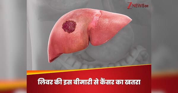 Fatty Liver Disease May Increase Risk Of Caner in Long Term Says AIIMS ...