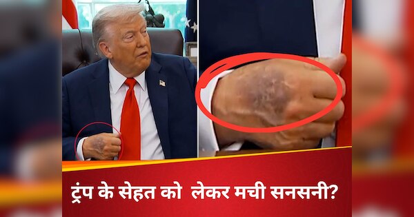 Trump reveals dark bruising on hand cover up in Oval Office know truths ...