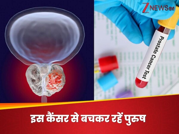 Prostate Cancer Male Private Part Gland Its Symptoms Which is ...
