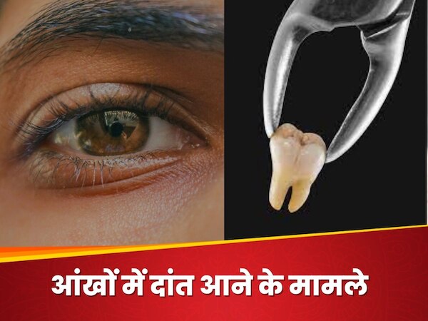 How Tooth Found in Eye Rare Medical Case In India Patna Bihar IGIMS ...