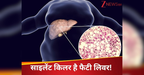 fatty liver side effects | साइलेंट किलर है फैटी लिवर | fatty liver ...