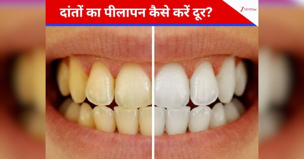 How To Clean Yellow Teeth and Make Them Milky White Danton Ka Peelapan ...