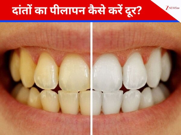 How To Clean Yellow Teeth and Make Them Milky White Danton Ka Peelapan ...