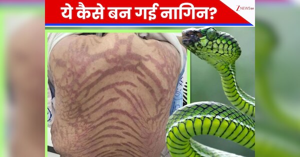 Chinese Woman Develops Snake Like Skin After Using Pure Herbal Cream ...