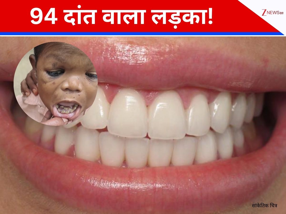 94 dant wala ladka boy with 94 teeth goes viral internet stunned watch ...