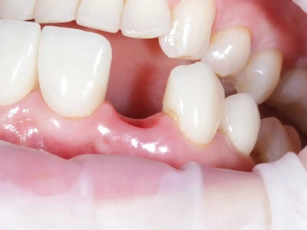 Japanese scientists claim they can re grow lost teeth again | दांत टूट ...