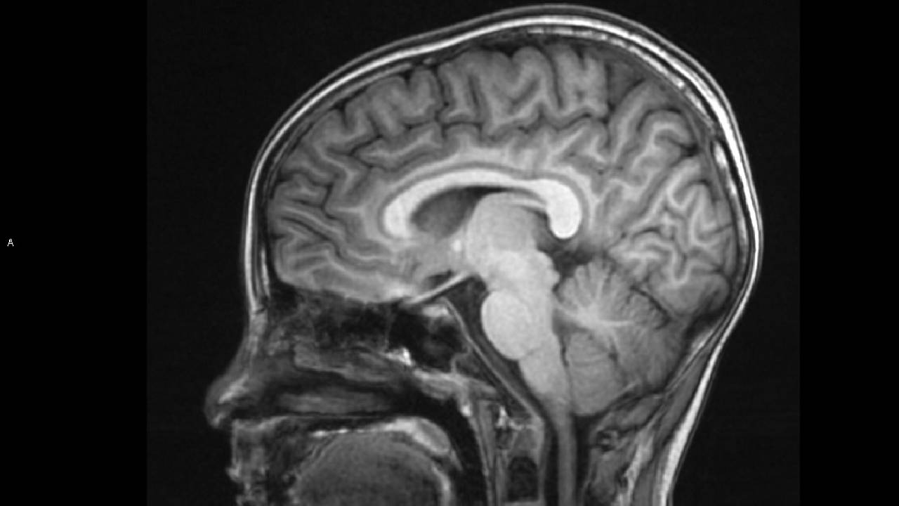 headache to difficulty speaking Neurology Dr explain brain tumour ...