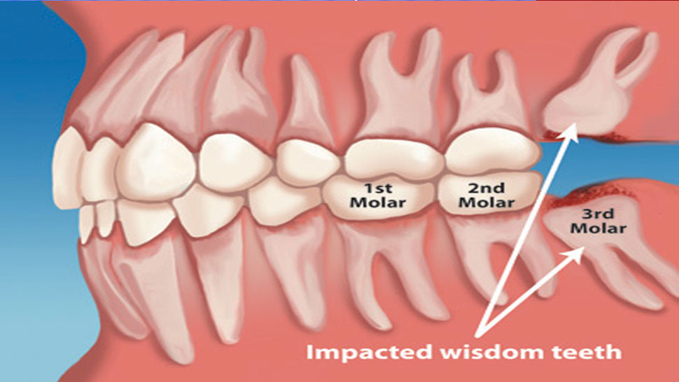Battisi of teeth is over now, Now only 28 teeths are growing in the ...