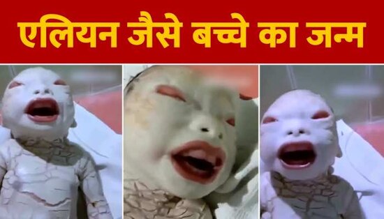 Alien Boy born mother gave birth child with harlequin ichthyosis rare ...